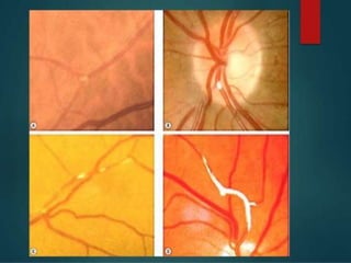 Macular cherry red spot | PPTX | Eye and Vision Conditions | Diseases ...