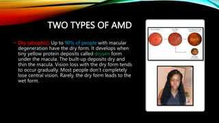 Macular Degeneration Presentation.pptx