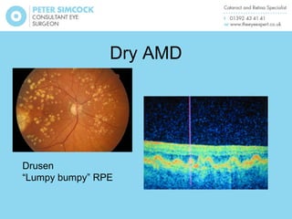 Macular degeneration treatments - an update for orthoptists | PPT