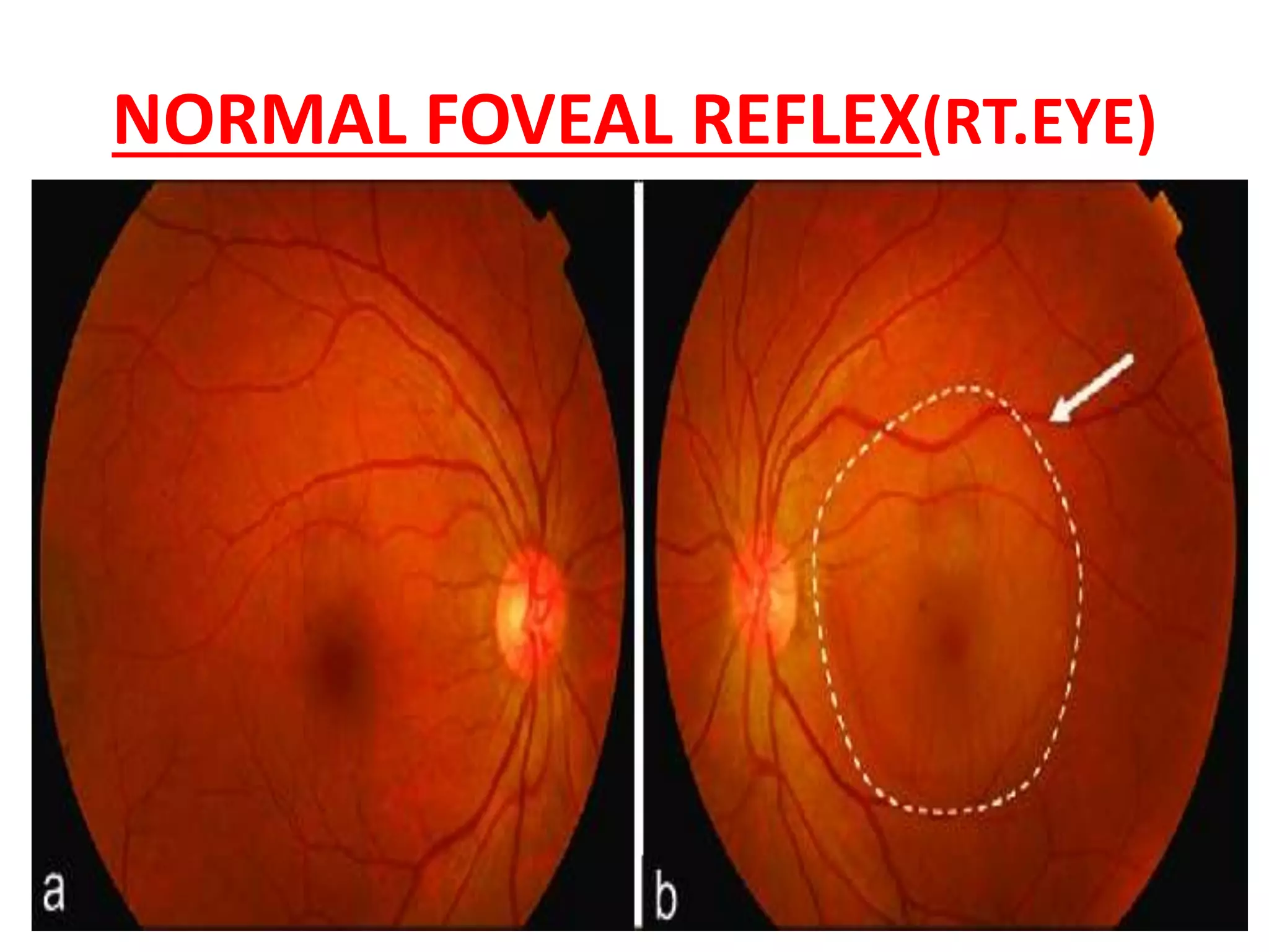 MACULAR DISORDERS.pptx