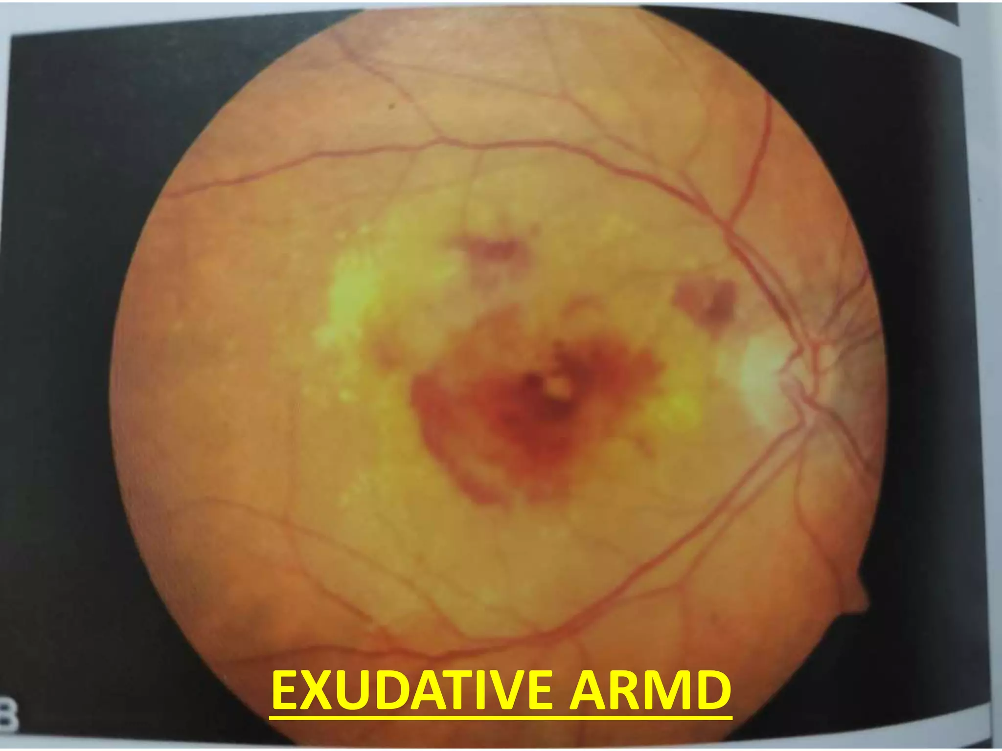 MACULAR DISORDERS.pptx