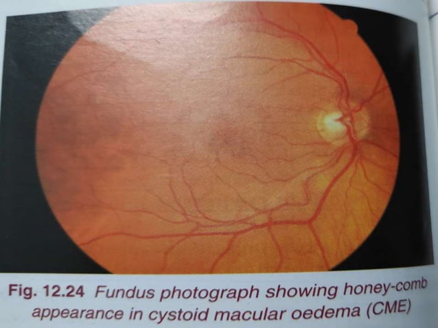 MACULAR DISORDERS.pptx | Eye and Vision Conditions | Diseases and ...