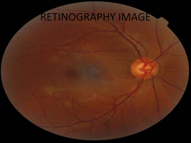 MACULAR DISORDERS.pptx | Eye and Vision Conditions | Diseases and ...