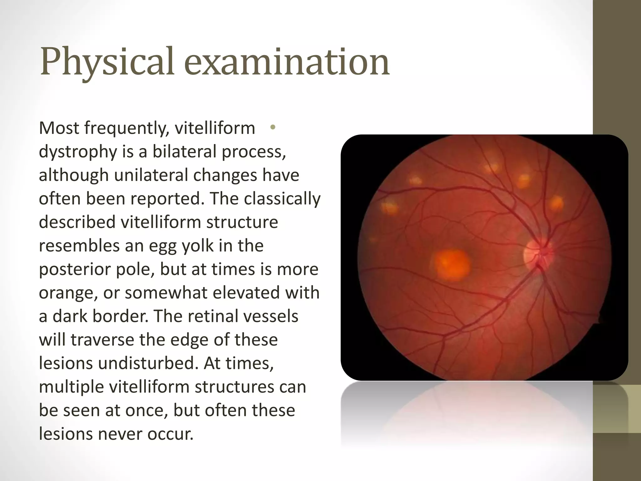 Macular disorders best disease | PPTX