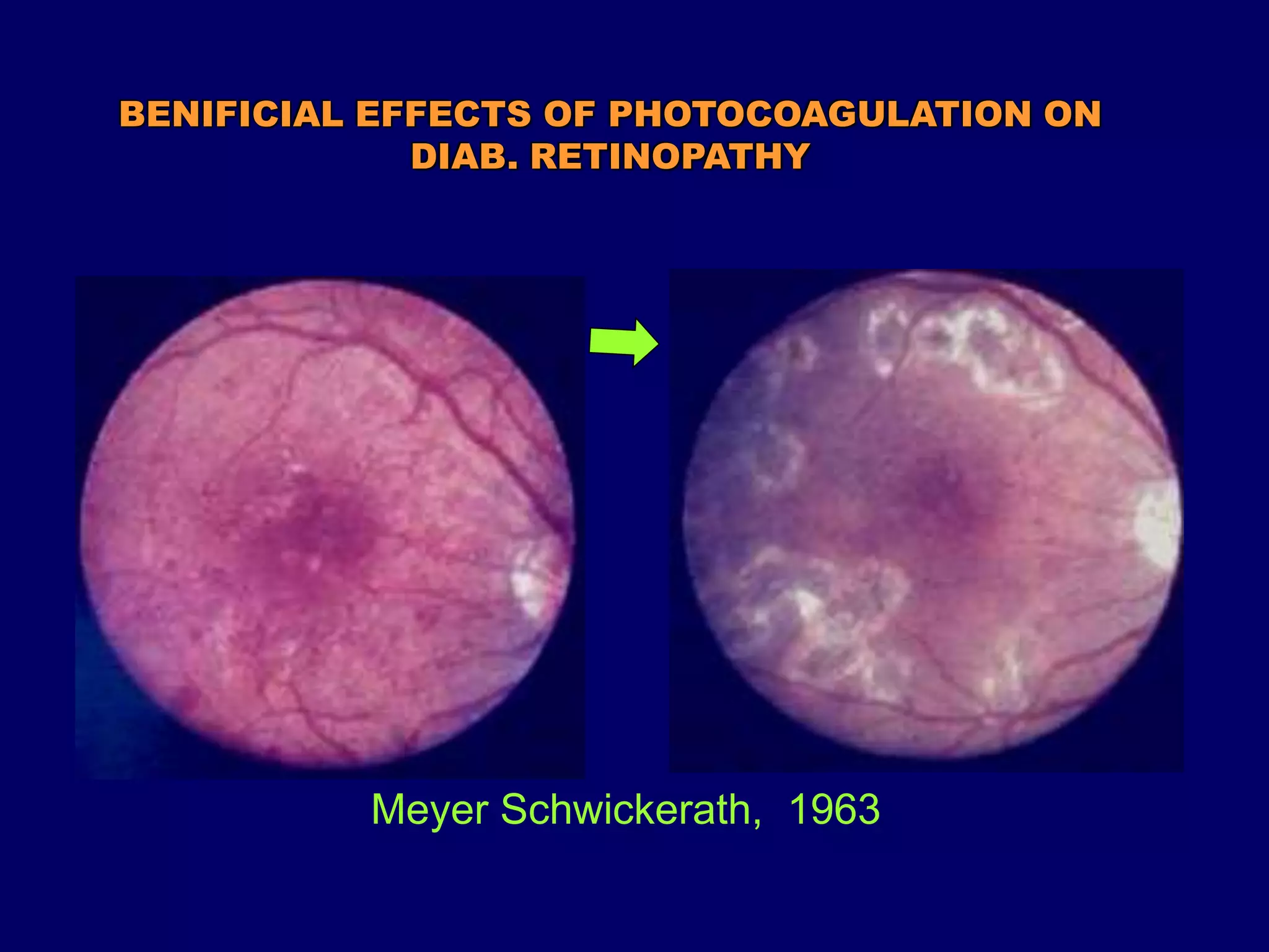 THE RATIONALE AND TECHNIQUE OF LASER TREATMENT OF DIAB. RET ...