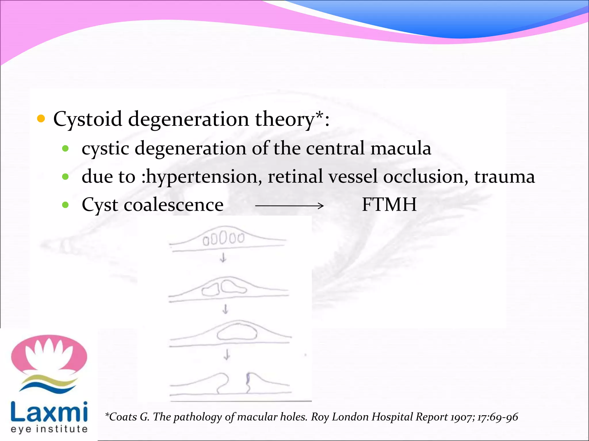 Macular hole | PPTX