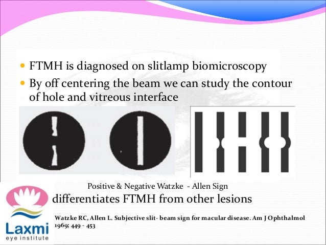 Macular hole