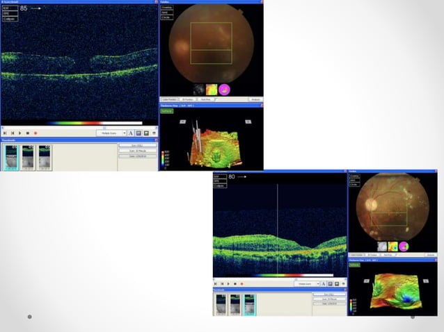 ILM Friend or Foe | PPTX | Eye and Vision Conditions | Diseases and ...