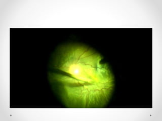 ILM Friend or Foe | PPTX | Eye and Vision Conditions | Diseases and ...