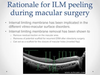 ILM Friend or Foe | PPTX | Eye and Vision Conditions | Diseases and ...