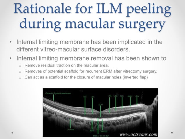 ILM Friend or Foe | PPTX | Eye and Vision Conditions | Diseases and ...