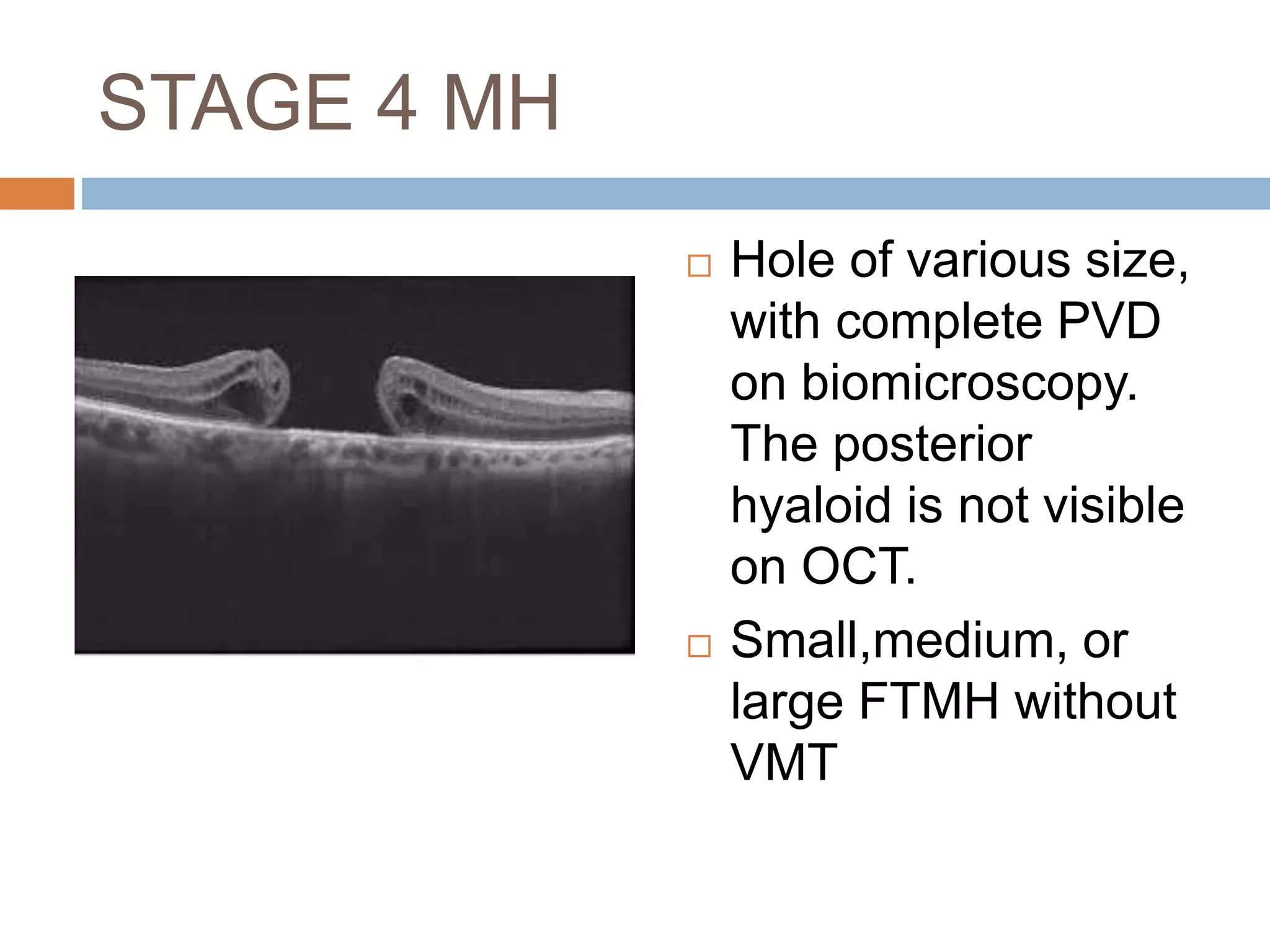 MACULAR HOLE.pptx