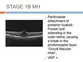 MACULAR HOLE.pptx