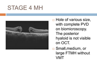 MACULAR HOLE.pptx
