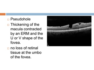 MACULAR HOLE.pptx