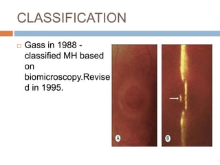 MACULAR HOLE.pptx