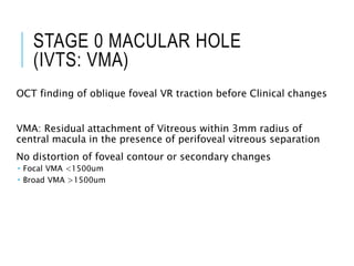 macular hole.pptx