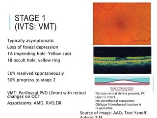 macular hole.pptx