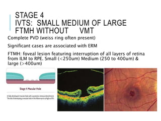 macular hole.pptx
