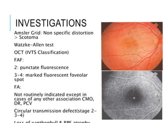 macular hole.pptx