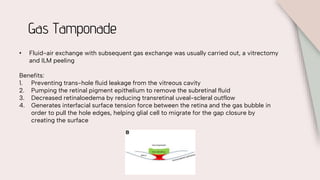 power point presentation of Macular Hole.pptx