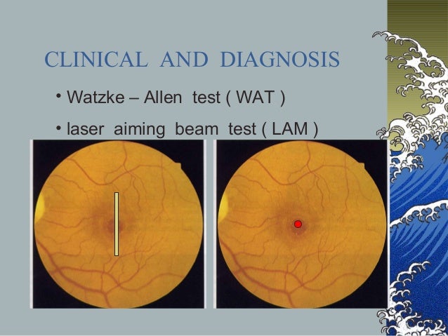 NW2010 Macular hole