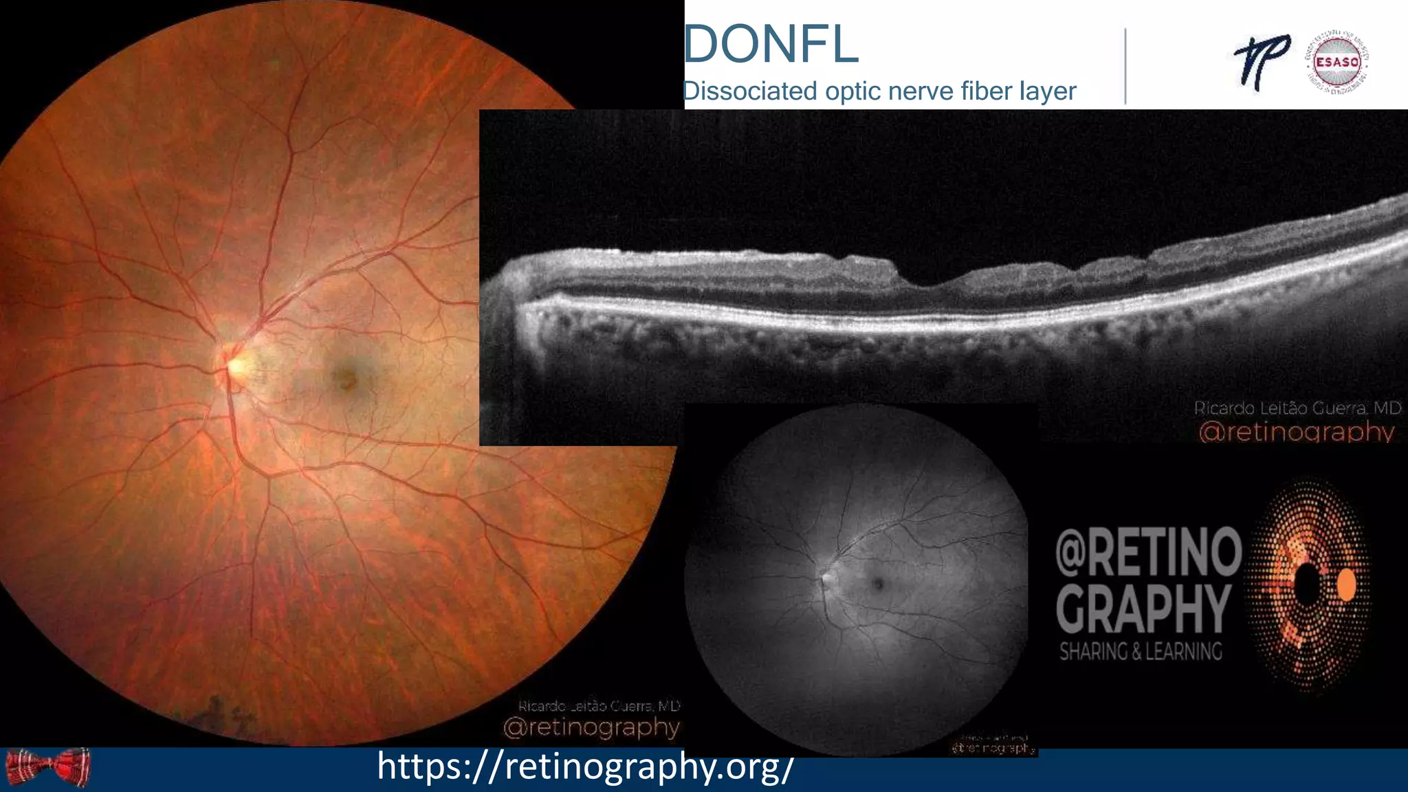 MACULAR HOLE in MYOPIC EYES DrCanali 20 Aprile23 Lugano.pptx