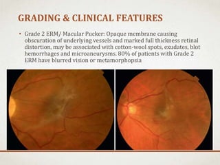 Macular hole | PPTX
