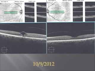 macular hole story.ppt dr Nagla hassan showed how macular hole can regress | PPT