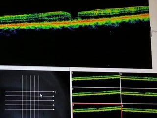 macular hole story.ppt dr Nagla hassan showed how macular hole can regress | PPT