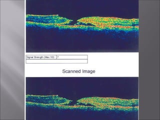 macular hole story.ppt dr Nagla hassan showed how macular hole can regress | PPT