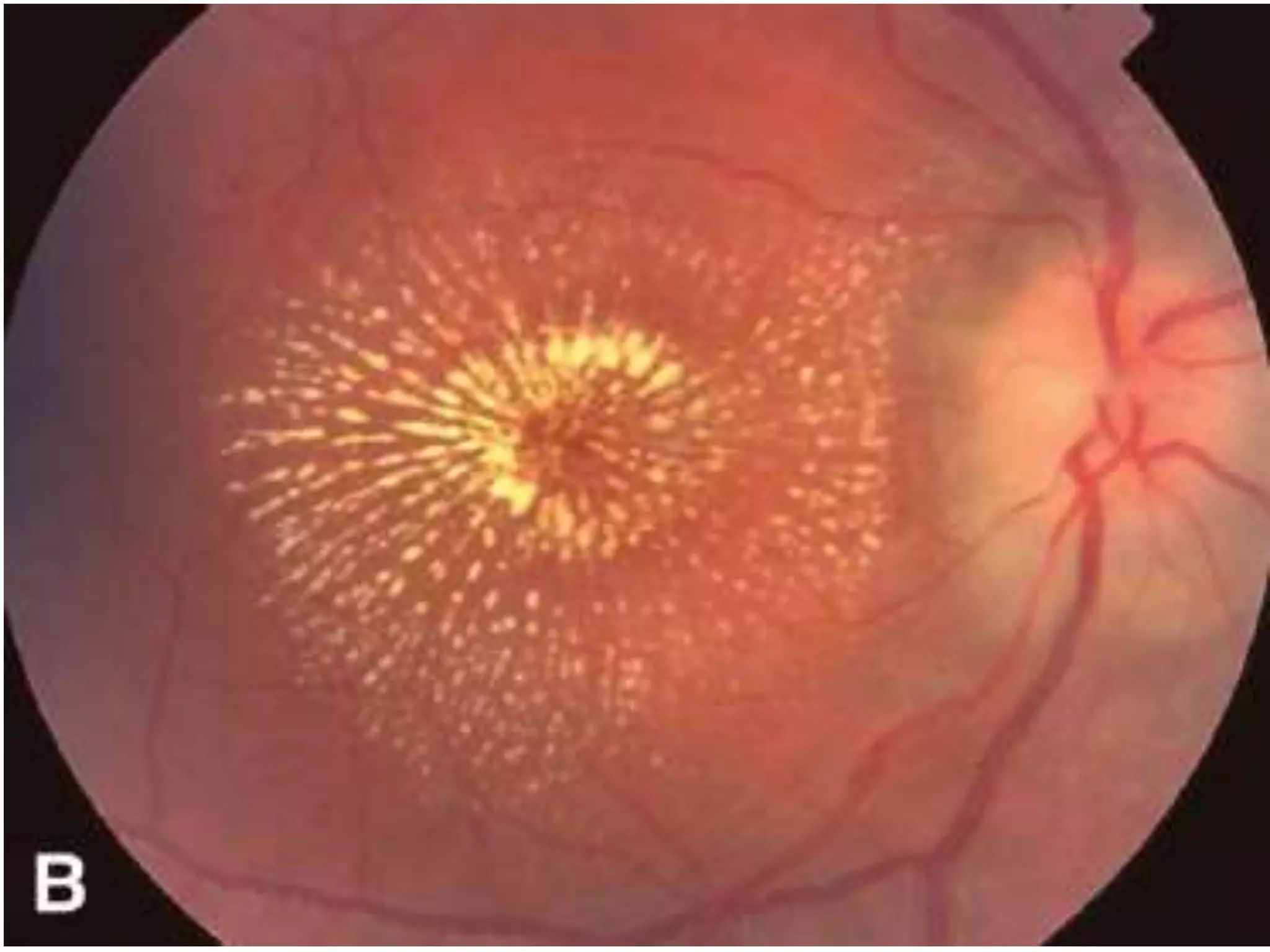 Macular star | PPTX