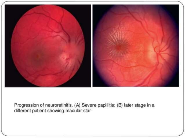 Macular star | PPTX