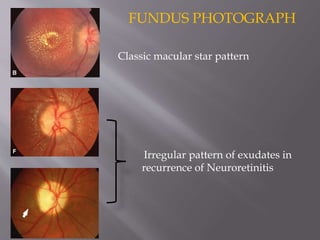 Macular Star.pptx