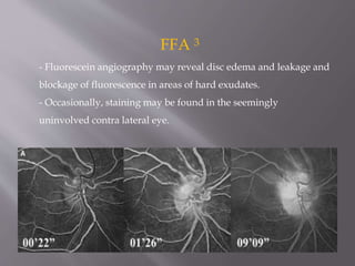 Macular Star.pptx