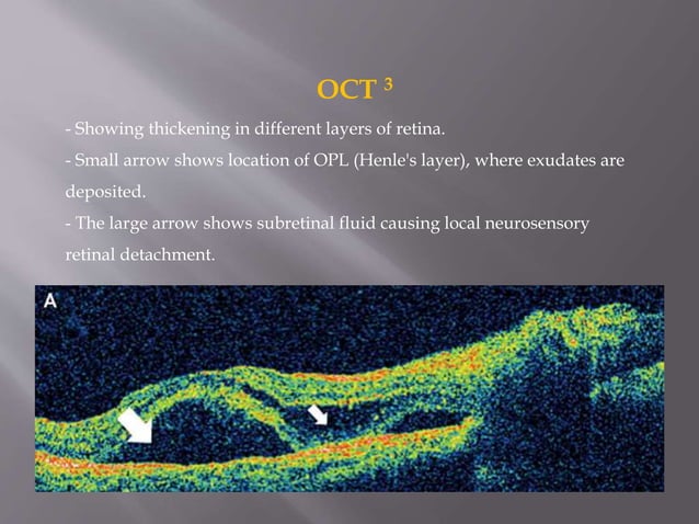 Macular Star.pptx