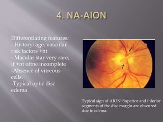 Macular Star.pptx