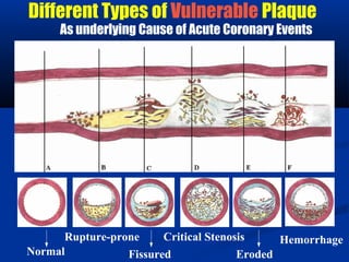 Vulnerable plaque vulnerable patient | PPT