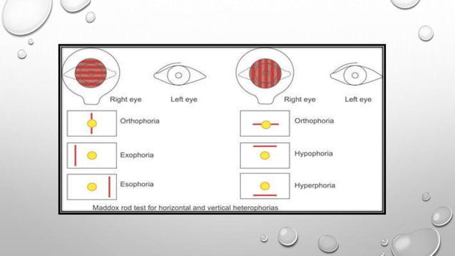 Maddox Rod-1.pptx Optometry Third year.. | PPT