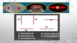 Maddox Rod-1.pptx Optometry Third year.. | PPTX