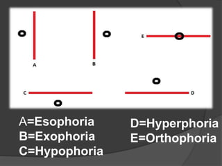 Maddox rod n wing | PPTX