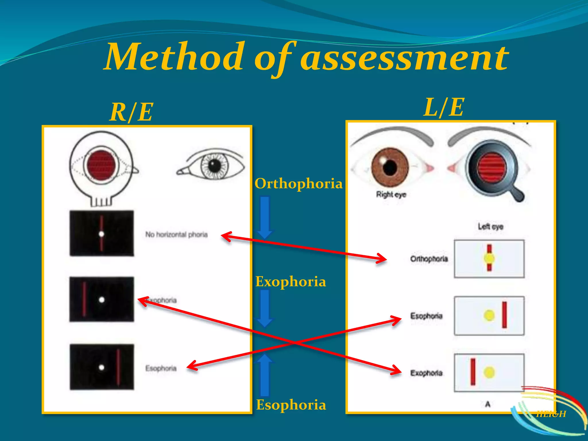 Maddox Rod test | PPTX