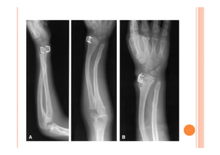 Madelung and multiple exostoses | PDF