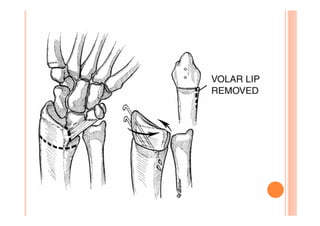 Madelung and multiple exostoses | PDF