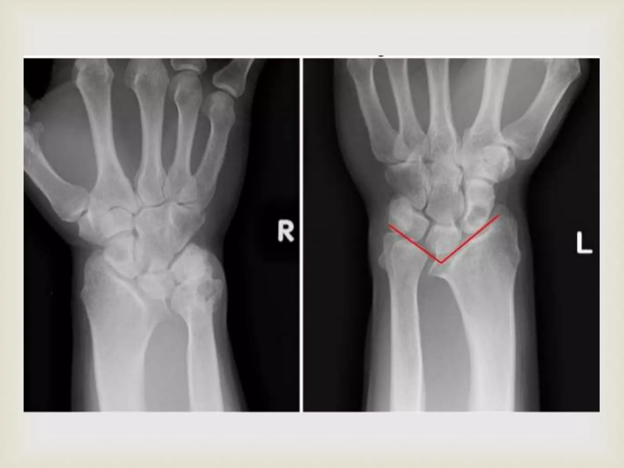 Madelung deformity | PPTX