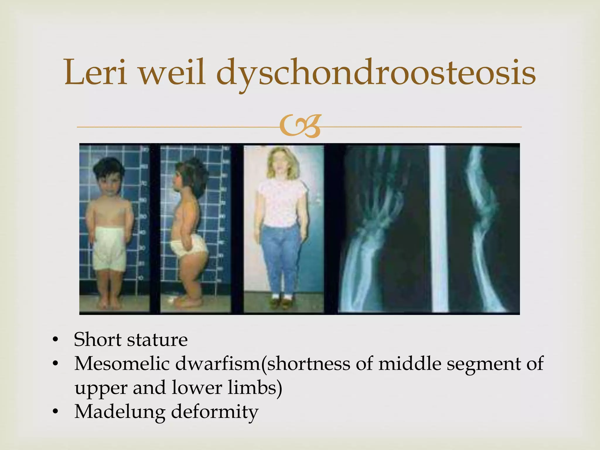 Madelung deformity | PPTX