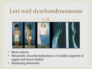 Madelung deformity | PPTX