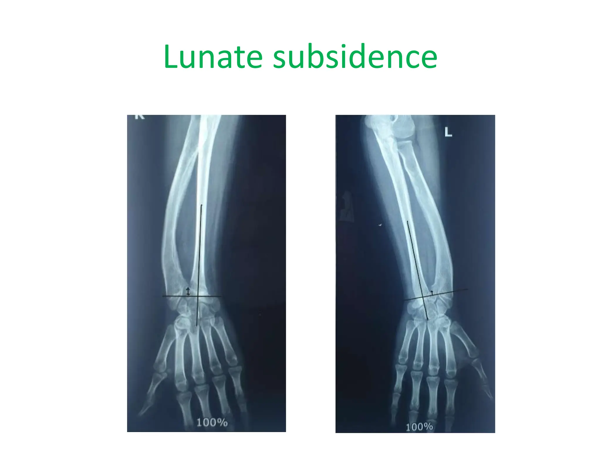 Madelung's deformity by Dr Monir Green 1.pptx