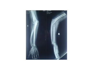 Madelung's deformity by Dr Monir Green 1.pptx