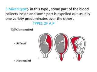 Abruptio Placentae Types